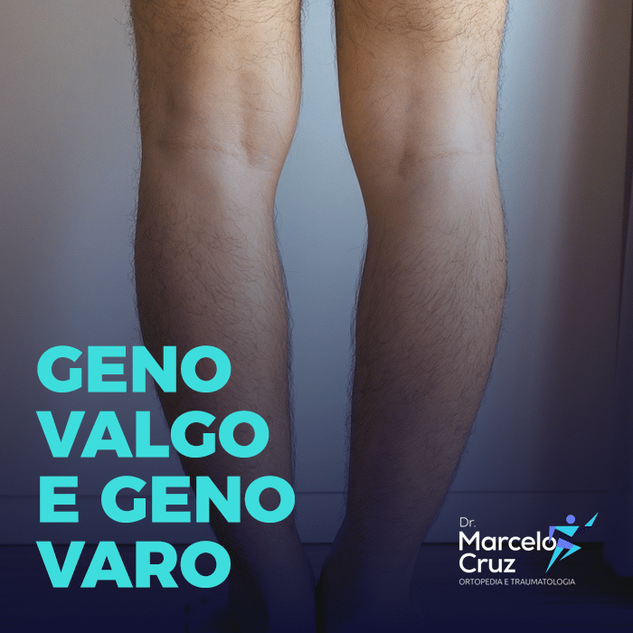 O que é geno valgo e geno varo? - Dr. Marcelo Cruz