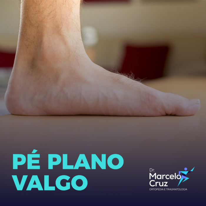 Quando é preciso tratar o pé plano? - Dr. Marcelo Cruz