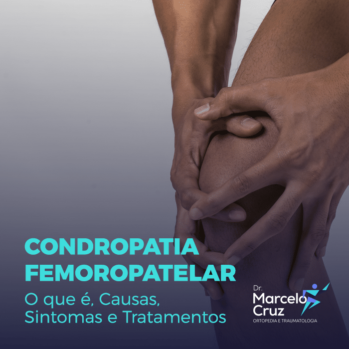 Condropatia Femoropatelar: O que é, Causas, Sintomas e Tratamentos - Dr ...